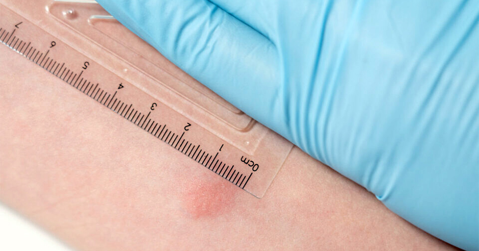 Reportan exposición a tuberculosis en la escuela secundaria Sweetwater ...