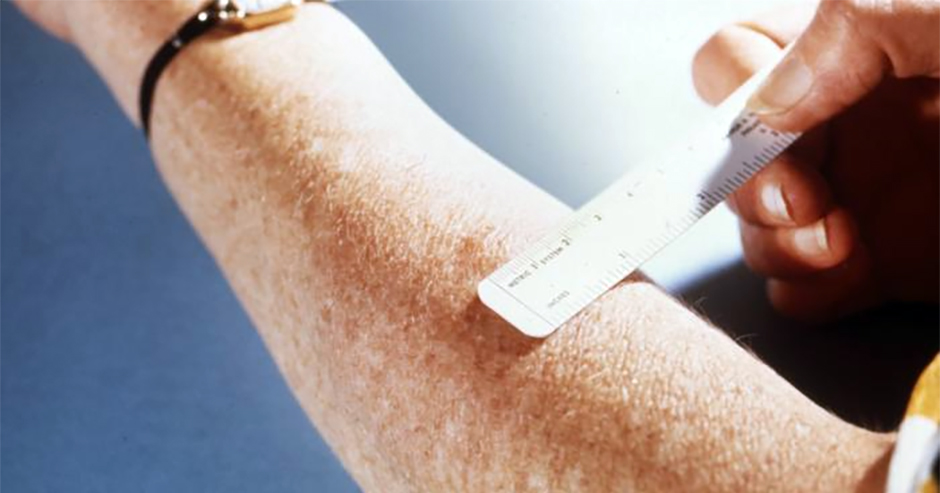 Detectan exposición a tuberculosis en Mount Miguel High School ...